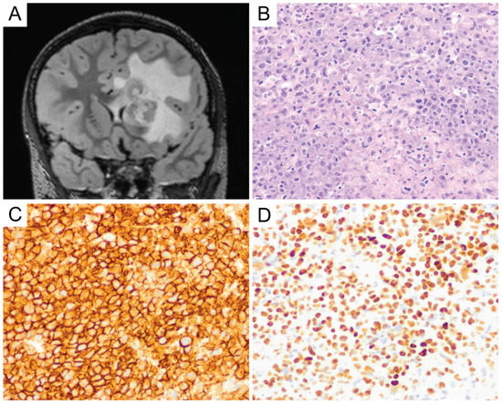 Primary Central Nervous System Lymphomas: A Diagnostic Overview of Key Histomorphologic ...