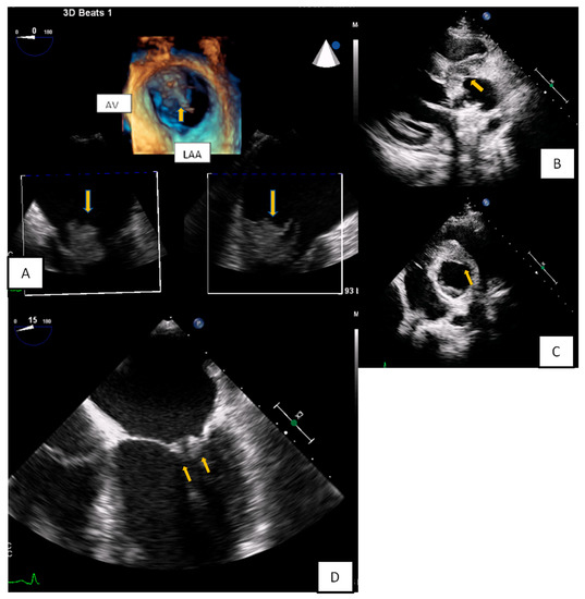 Cardiac Masses: The Role of Cardiovascular Imaging in the Differential ...