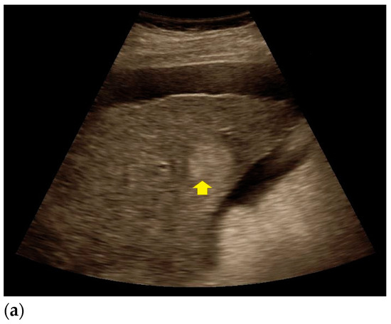 Diagnostics | Special Issue : Abdominal Ultrasound and Treatment of ...