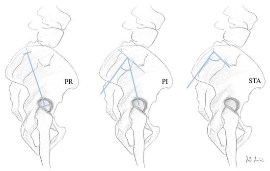 Diagnostics | Free Full-Text | Changes of Fixed Anatomical Spinopelvic ...