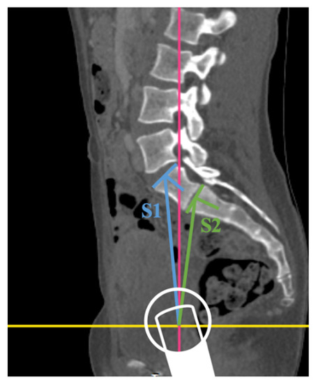 Changes of Fixed Anatomical Spinopelvic Parameter in Patients with ...