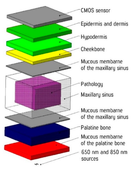 Optical Diagnostics of the Maxillary Sinuses by Digital Diaphanoscopy ...