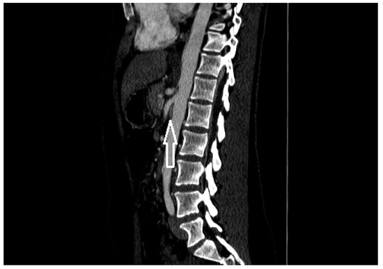 Diagnostics Free Full Text From Nutcracker Phenomenon To Nutcracker