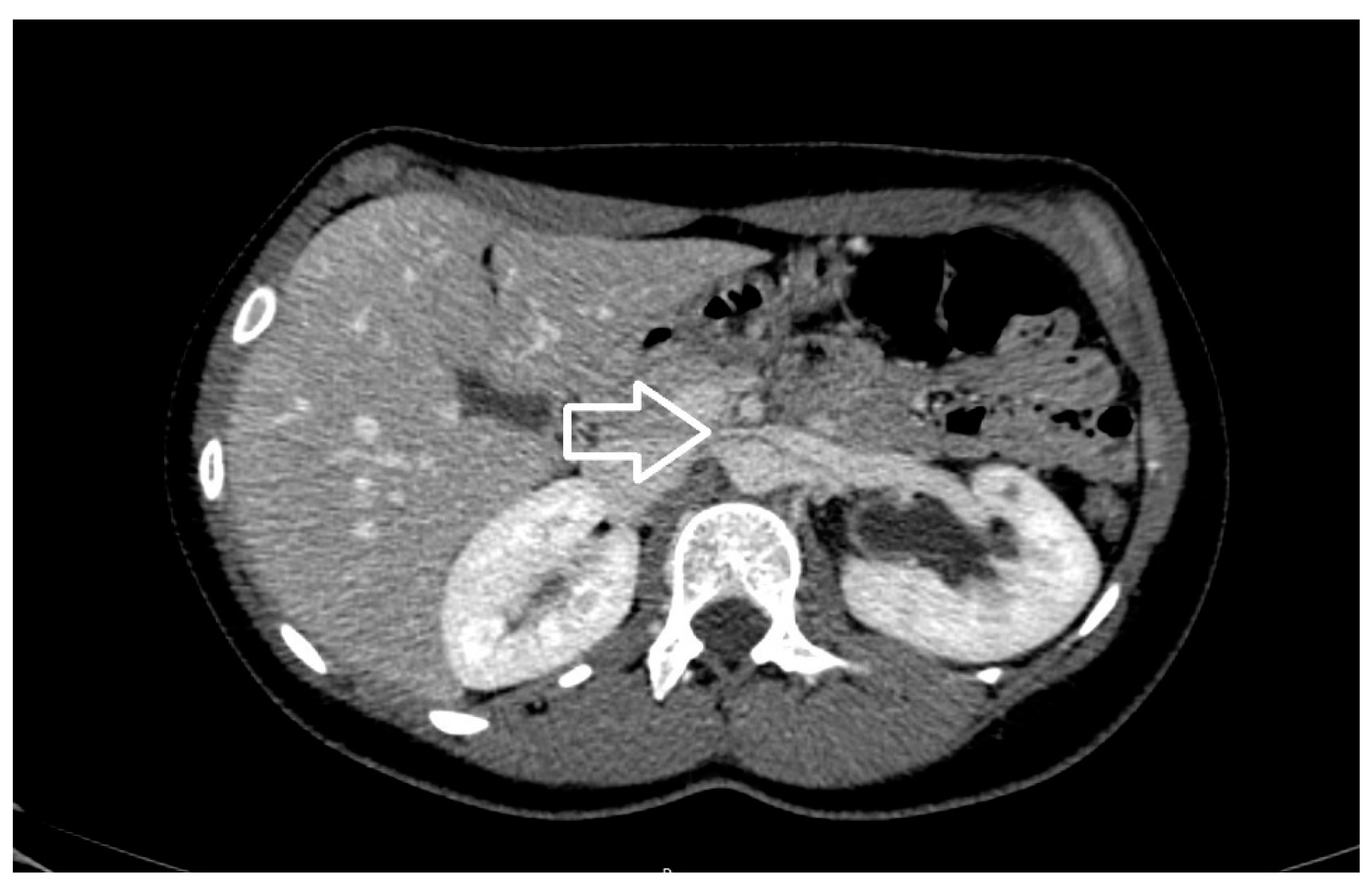 Diagnostics Free Full Text From Nutcracker Phenomenon To Nutcracker