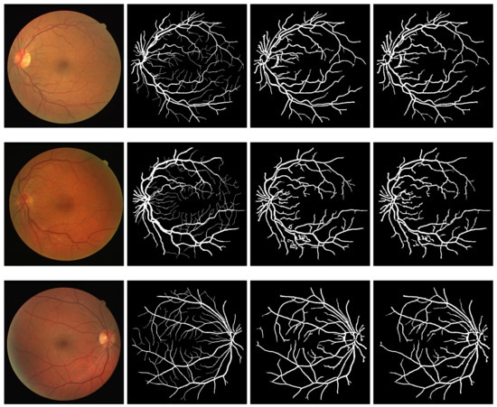 Towards Automated Eye Diagnosis: An Improved Retinal Vessel ...
