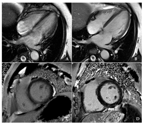Bolus Intravenous Procainamide in Patients with Frequent Ventricular ...