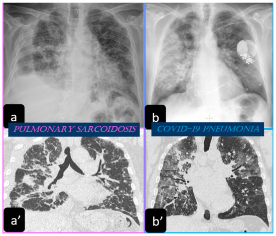 Diagnostics | Free Full-Text | Chest Imaging of Patients with ...