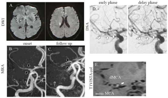 Analysis for Stroke Etiology in Duplicated/Accessory MCA-Related ...