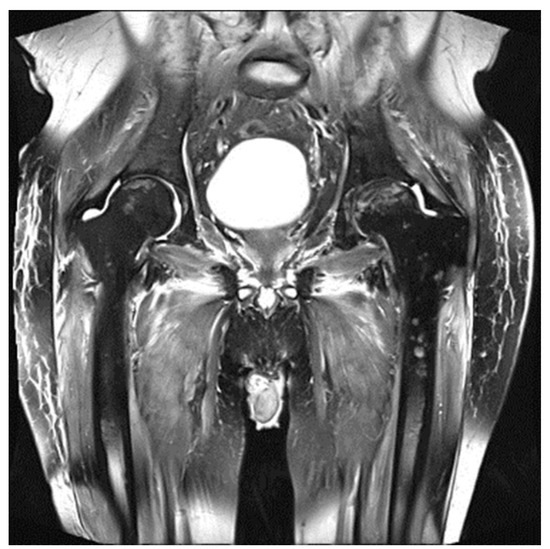 Positron Emission Tomography (PET) Imaging of Multiple Myeloma in a ...
