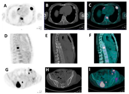 Positron Emission Tomography (PET) Imaging of Multiple Myeloma in a ...
