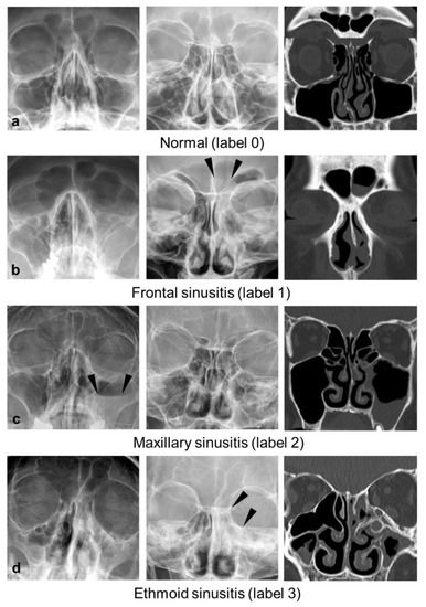 Deep Learning for Diagnosis of Paranasal Sinusitis Using Multi-View ...