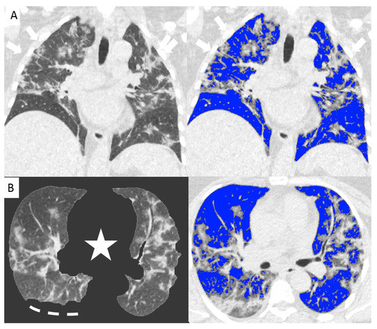 Quantitative Evaluation of COVID-19 Pneumonia Lung Extension by ...