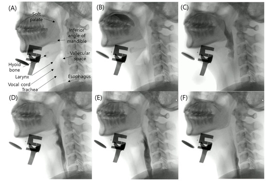 Automatic Pharyngeal Phase Recognition in Untrimmed Videofluoroscopic Swallowing Study Using ...