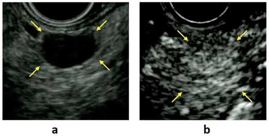 Diagnostics | Free Full-Text | Role of Endoscopic Ultrasound in the Diagnosis of Pancreatic ...