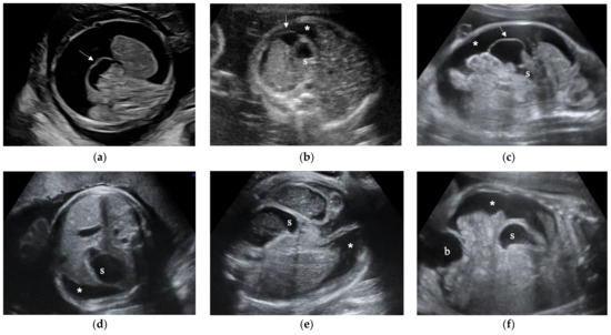 Wavy Floating Greater Omentum Findings Are Useful for Differentiating ...