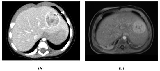 Pediatric Primary Hepatic Tumors: Diagnostic Considerations