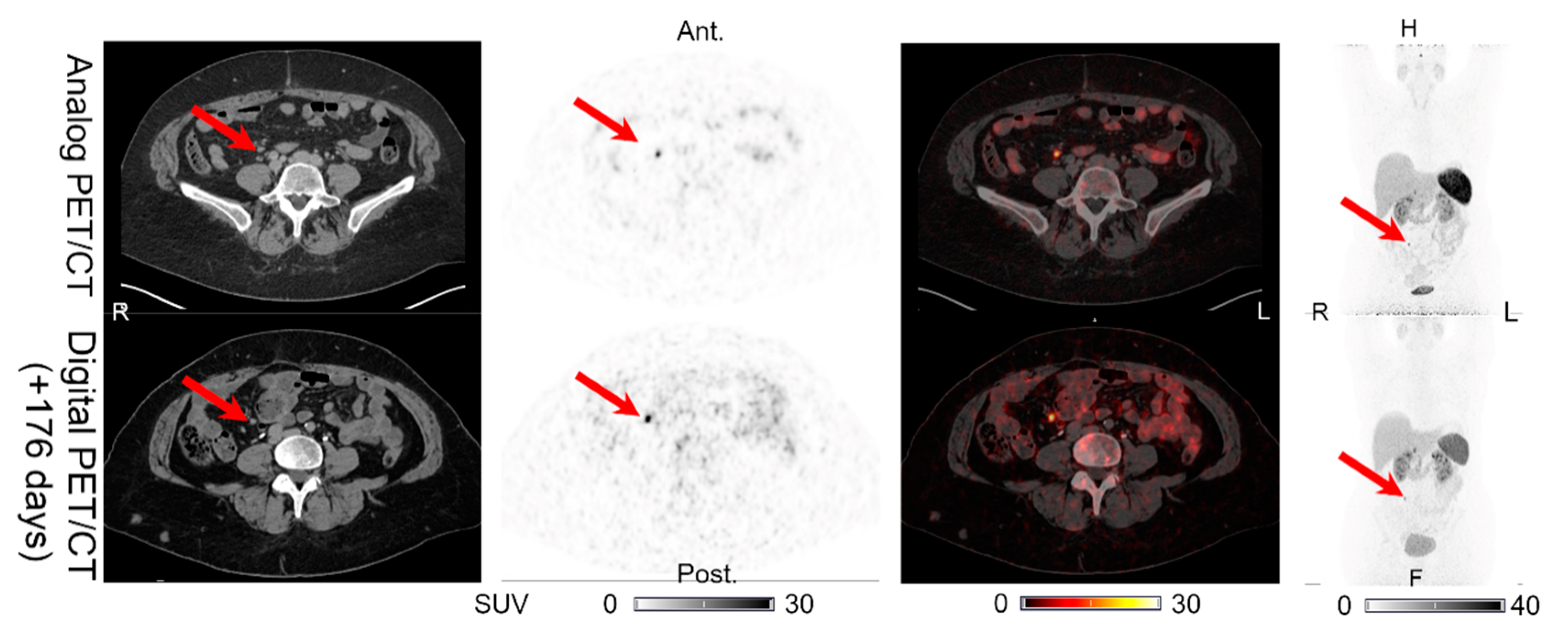 Diagnostics | Free Full-Text | Initial Experience with 64Cu-DOTATATE ...