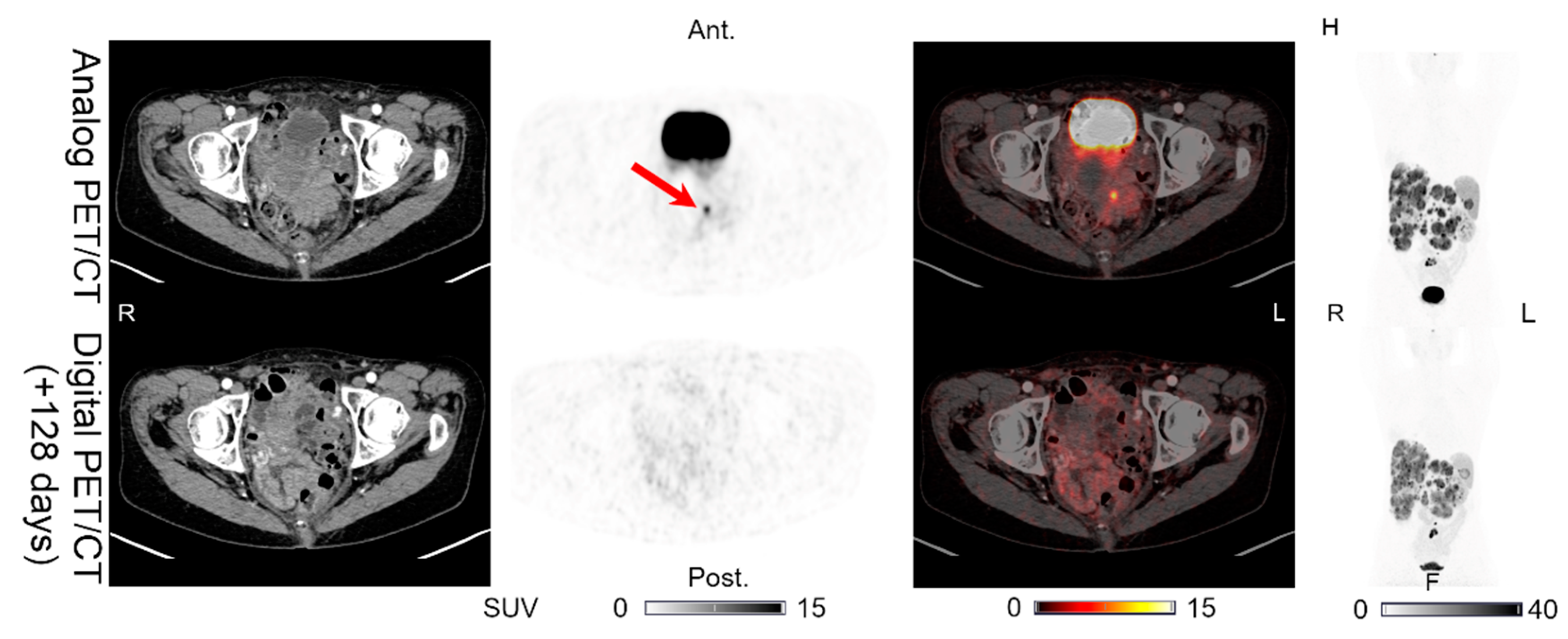 Diagnostics | Free Full-Text | Initial Experience with 64Cu-DOTATATE ...
