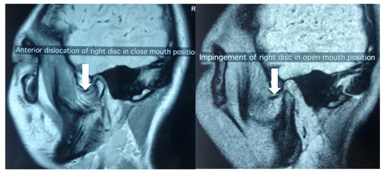 Temporomandibular Disorders: Current Concepts and Controversies in ...