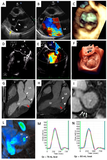 Arrhythmic Mitral Valve Prolapse: Introducing an Era of Multimodality ...