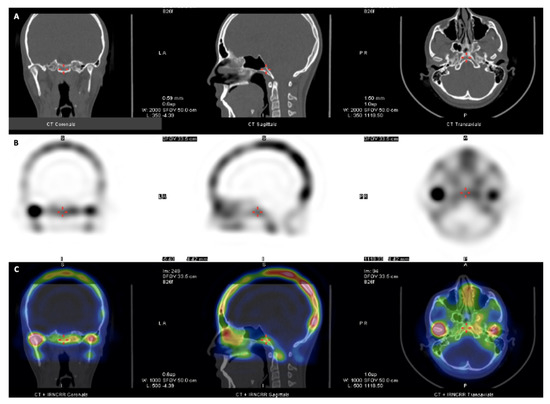 SPECT/CT Correlation in the Diagnosis of Unilateral Condilar Hyperplasia