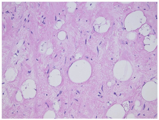 MDM2 Amplified Sarcomas: A Literature Review
