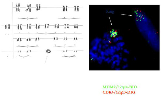 MDM2 Amplified Sarcomas: A Literature Review