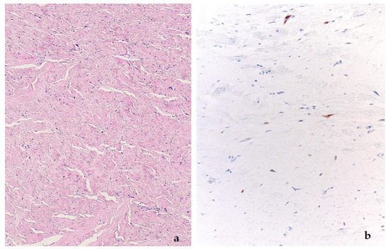 MDM2 Amplified Sarcomas: A Literature Review