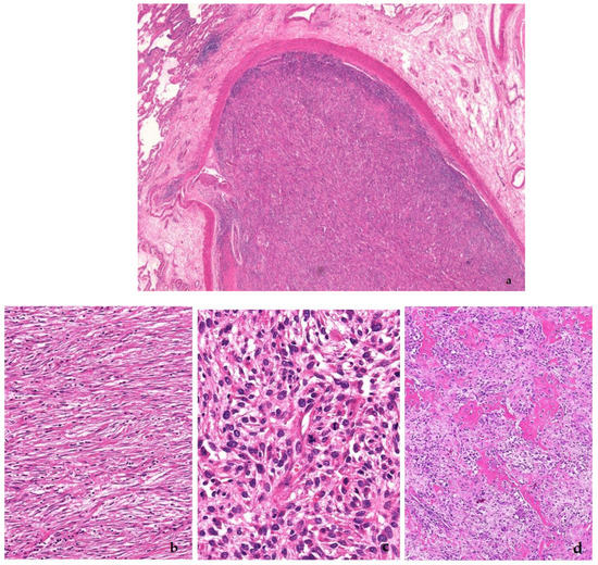 MDM2 Amplified Sarcomas: A Literature Review