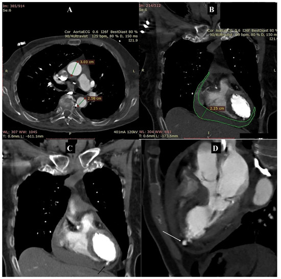 Left Ventricular Rupture as a Complication of Anterior Wall Myocardial ...