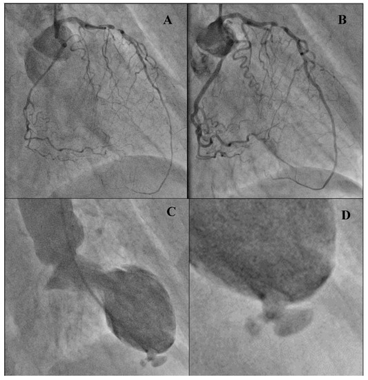 Left Ventricular Rupture as a Complication of Anterior Wall Myocardial ...