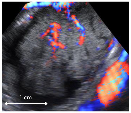 Diagnostics Free Full Text 4d Doppler Ultrasound In High Grade