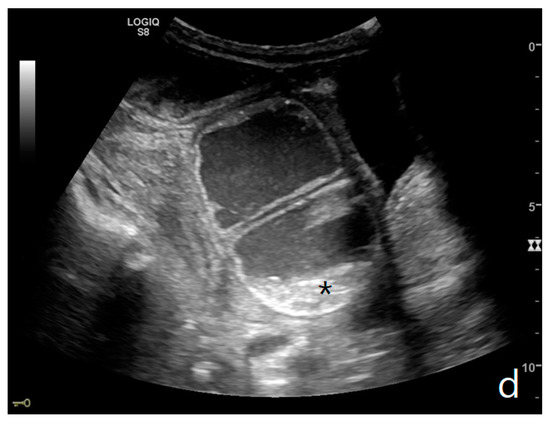 Ultrasound of Small Bowel Obstruction: A Pictorial Review