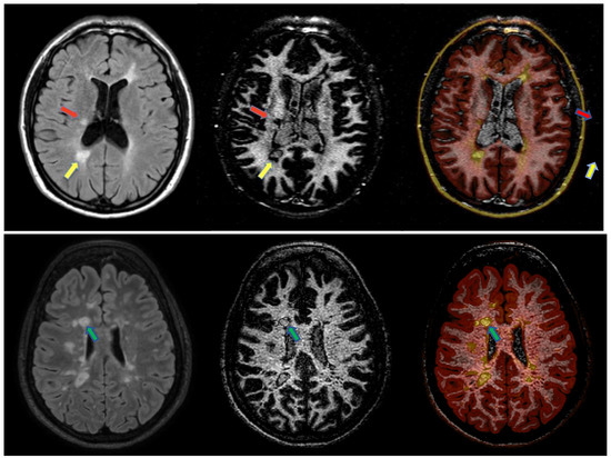 The Prognostic Value of White-Matter Selective Double Inversion ...