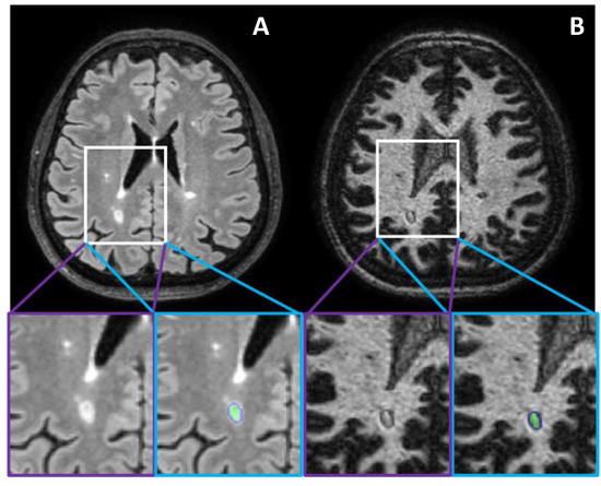 The Prognostic Value of White-Matter Selective Double Inversion ...