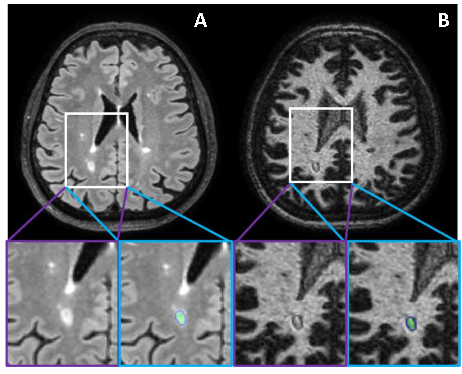 The Prognostic Value of White-Matter Selective Double Inversion ...