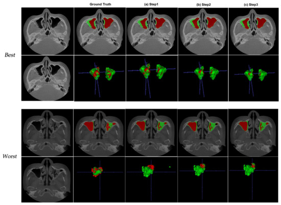 Deep Active Learning for Automatic Segmentation of Maxillary Sinus Lesions Using a Convolutional ...