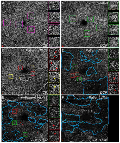 Diagnostics | Free Full-Text | Phenotypic Differences in a PRPH2 ...