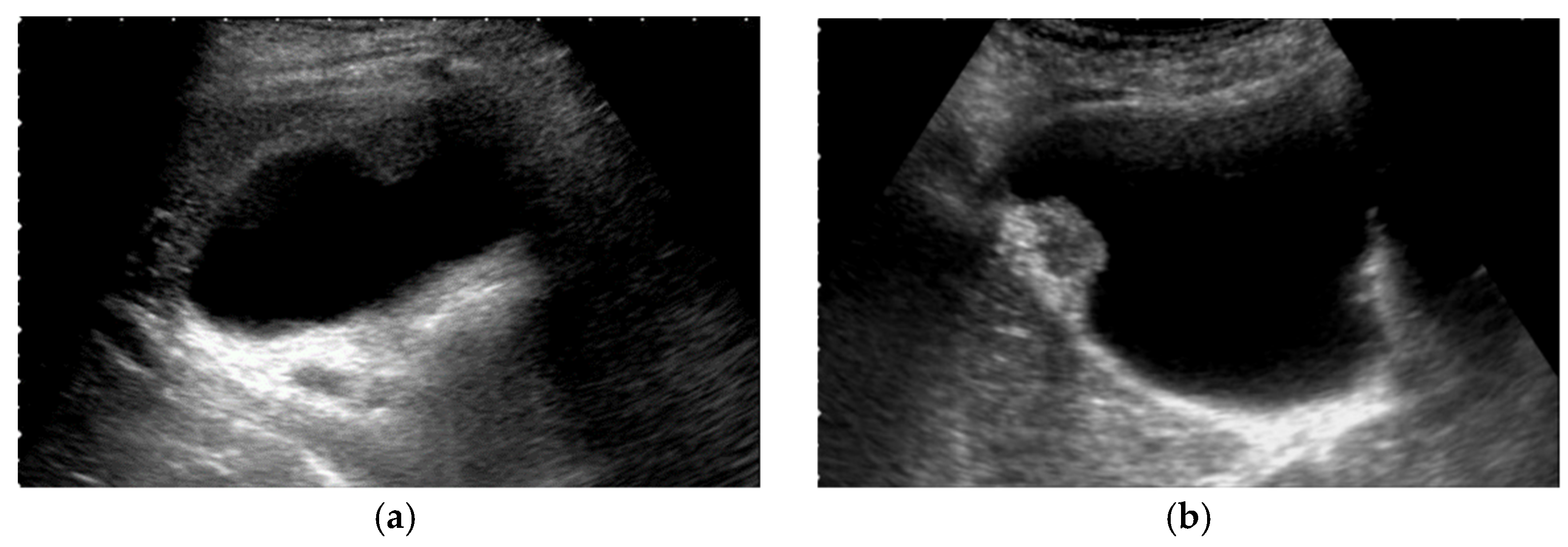 How Can We Manage Gallbladder Lesions by Transabdominal Ultrasound?