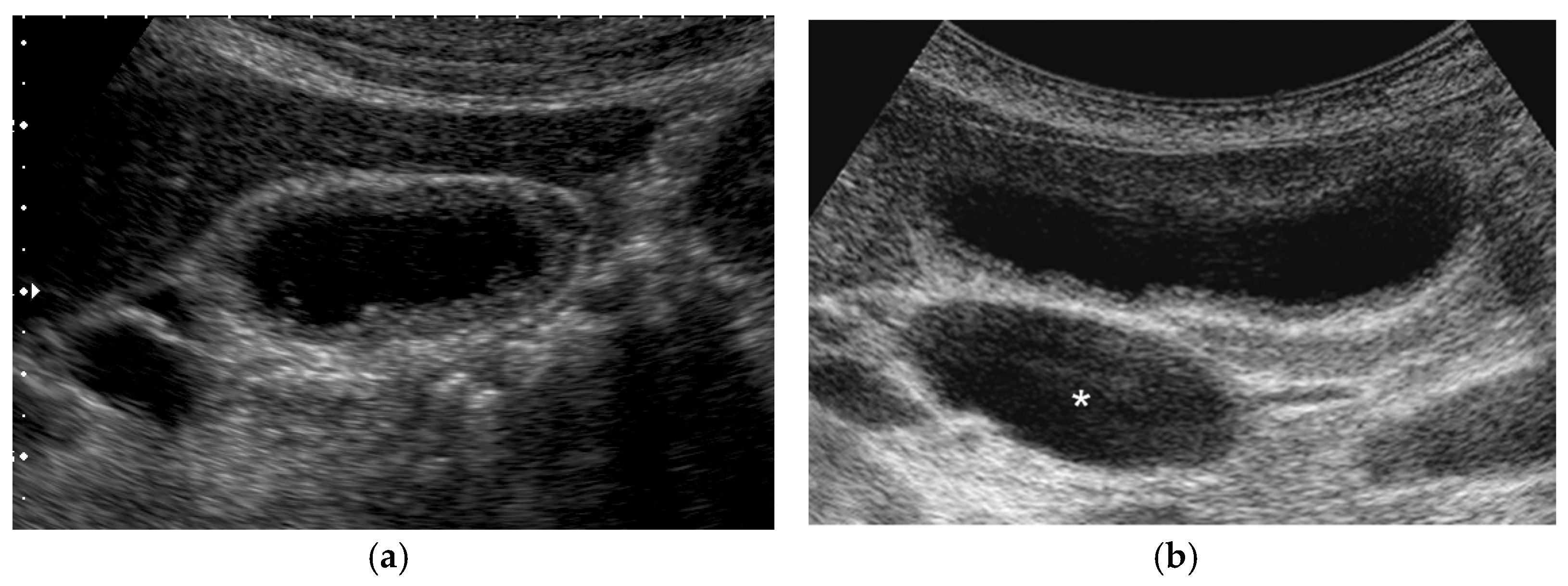 How Can We Manage Gallbladder Lesions by Transabdominal Ultrasound?