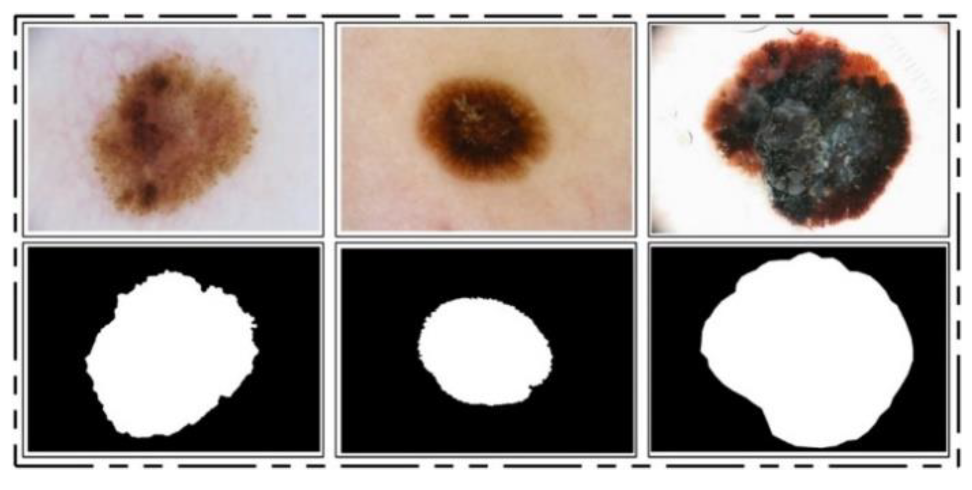 Skin Lesion Segmentation and Multiclass Classification Using Deep Learning Features and Improved ...