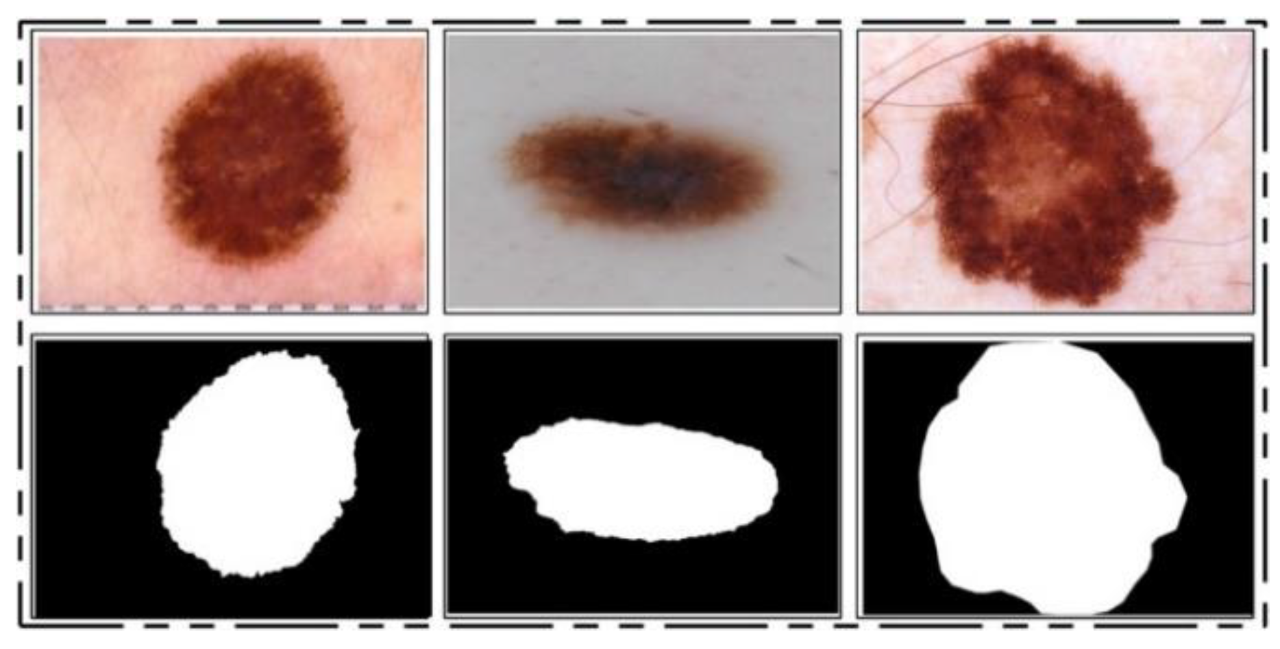 Skin Lesion Segmentation and Multiclass Classification Using Deep Learning Features and Improved ...