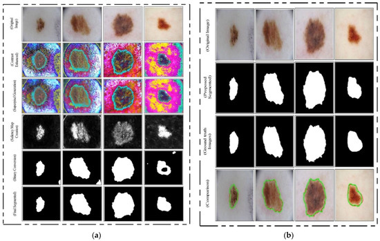 Skin Lesion Segmentation and Multiclass Classification Using Deep Learning Features and Improved ...