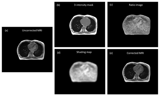 Applying MRI Intensity Normalization on Non-Bone Tissues to Facilitate ...
