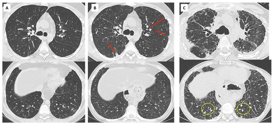 Diagnostics | Free Full-Text | Lung Transplantation: CT Assessment of ...