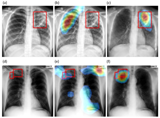 Chest X-ray Bone Suppression for Improving Classification of ...