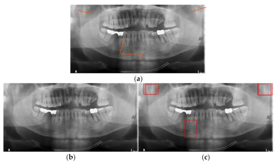 Automatic Detection of Mandibular Fractures in Panoramic Radiographs ...