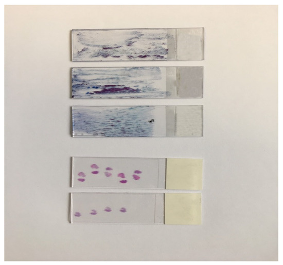 Diagnostic Three Slides Pap Test Compared to Punch Biopsy and ...