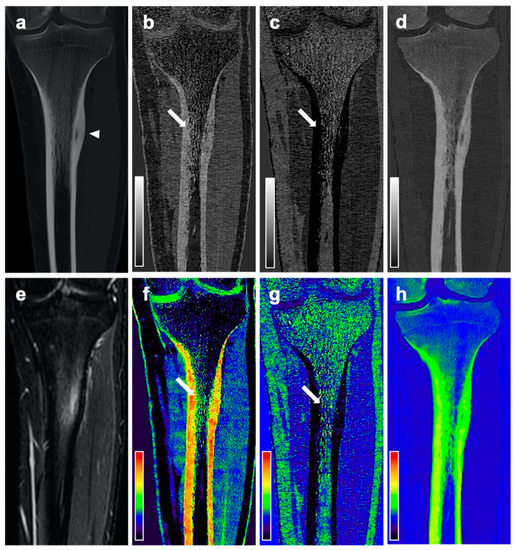Detection of Bone Marrow Edema in Patients with Osteoid Osteoma Using ...