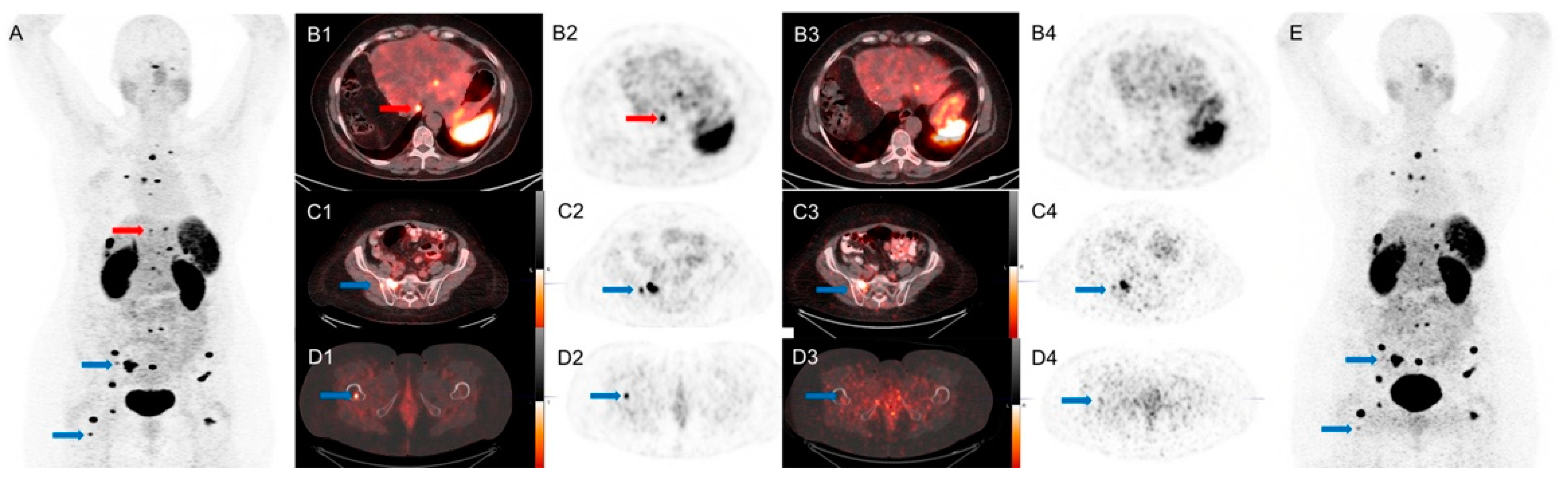 Results of a Prospective Trial to Compare 68Ga-DOTA-TATE with SiPM-Based PET/CT vs. Conventional ...